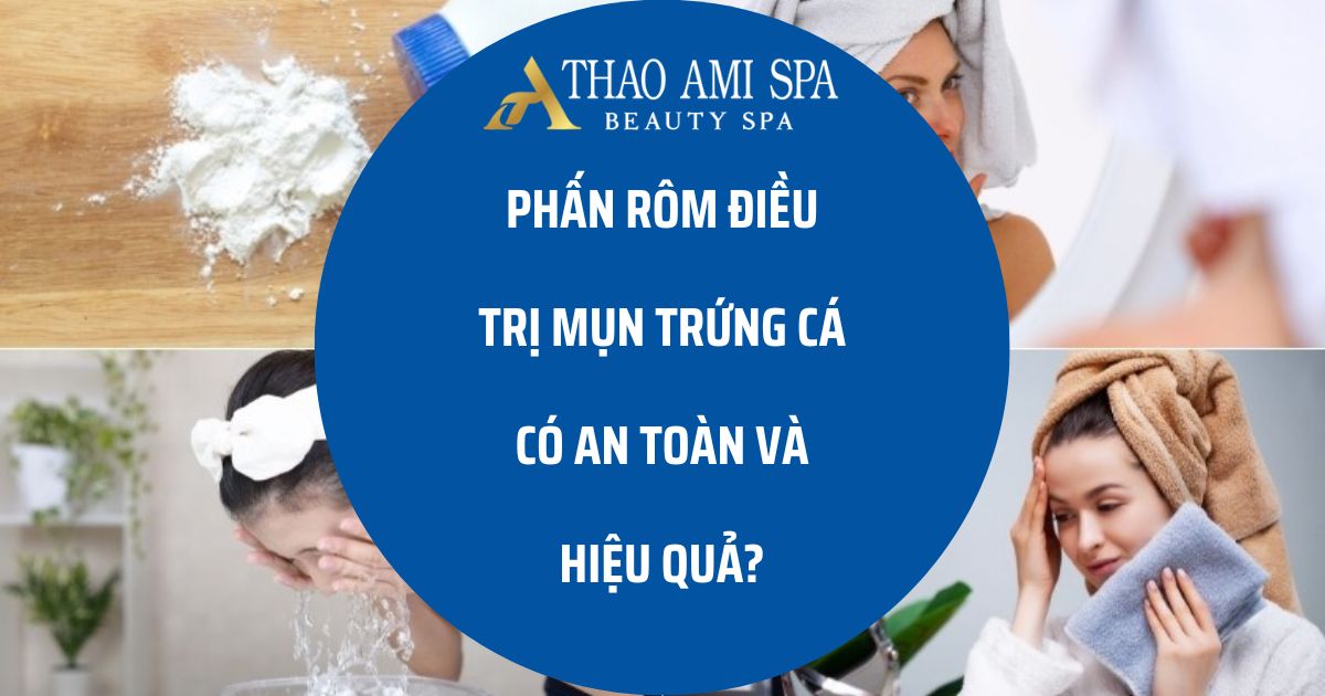 Phấn rôm có trị mụn được không?